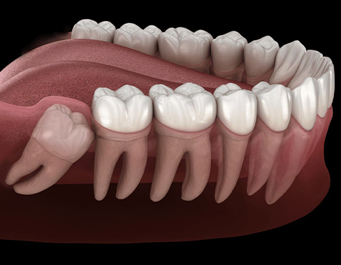 Extração de Siso em Icaraí - Niterói - Clínica Hathor
