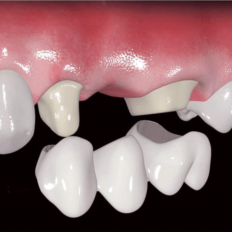 Prótese Dentária em Icaraí - Niterói - Clínica Hathor
